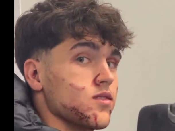 Soccer Tough: Barcelona's Pau Cubarsi Gets 10 Stitches After Getting ...