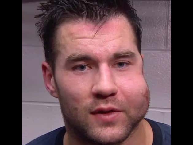 If You Squint You Can See The Swelling On Tom Wilson's Face Before He ...